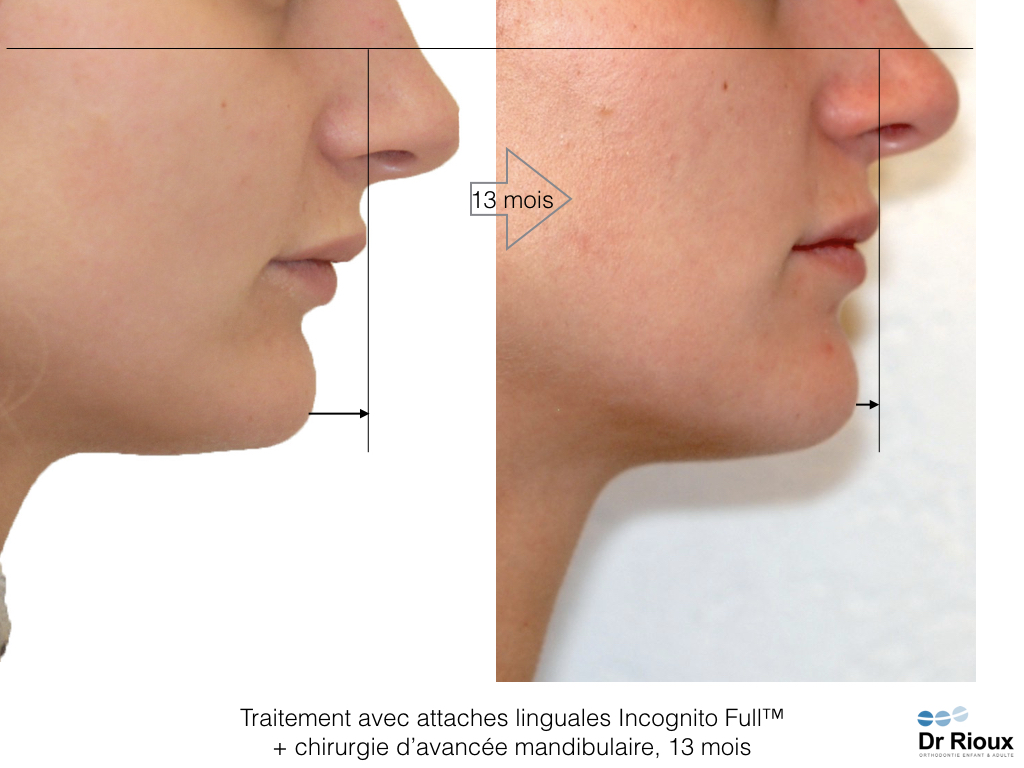 Chirurgie orthognathique - Orthodontie Lancy