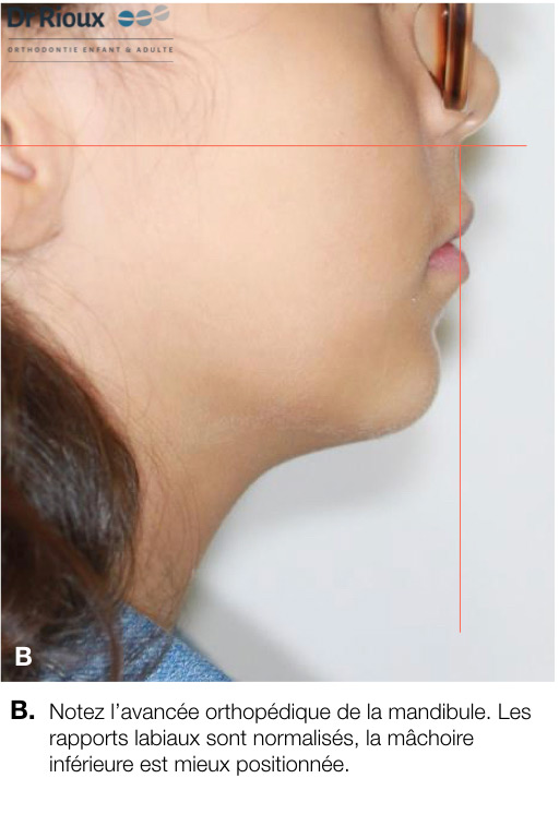 Croissance mâchoire inférieure - Orthodontie Lancy
