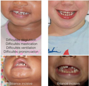 Pouces et lolettes - Orthodontie Lancy