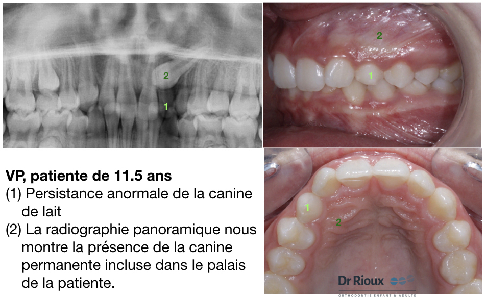 Problèmes d’éruption - Orthodontie Lancy